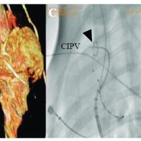 Pulmonary Vein Computed Tomography Angiography Cta And Dsa Images