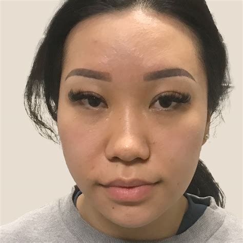 Non Surgical Rhinoplasty Seattle Non Invasive Rhinoplasty