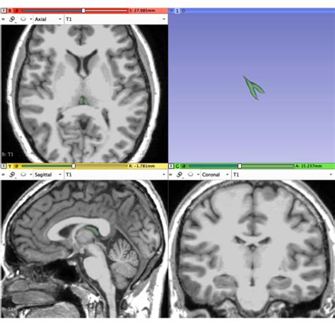 Manual Segmentation Of The Human Choroid Plexus Using Brain Mri