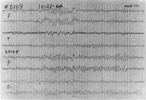 Figure 2 From Syndrome Of Akinetic Mutism Associated With Obstructive