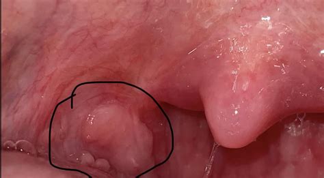 Tonsil Regrowth Rtonsilstones