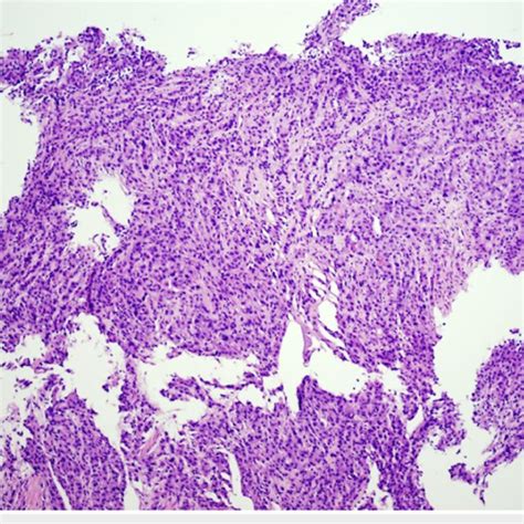 Gastric Biopsy Hande Staining 10x Showing Cells With Hepatoid