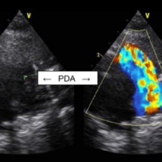 A PDA Visualized On Cardiac Catheterization B PDA With Amplatzer Download Scientific