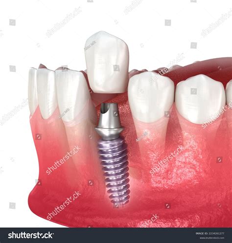Dental Implant Ceramic Crown Medically Accurate Stock Illustration
