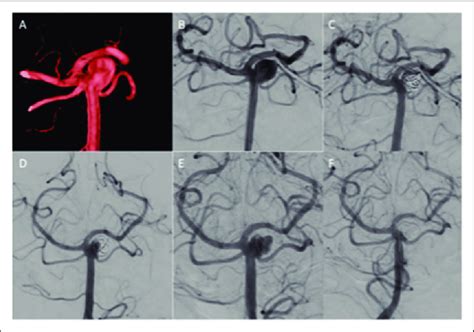 An Unruptured Basilar Tip Aneurysm Patient 12 A Was Treated With A Download Scientific