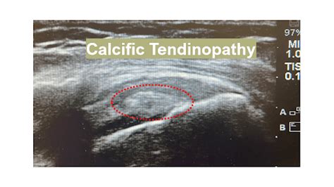 Calcific Tendonitis Of The Rotator Cuff What To Know