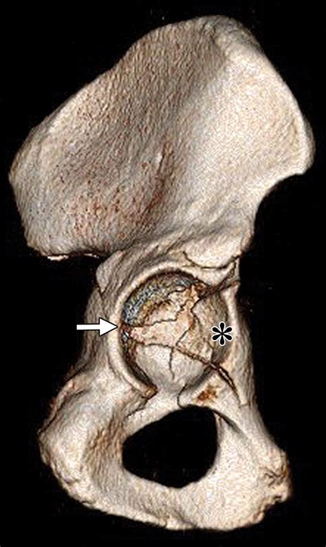 Acetabular Fractures What Radiologists Should Know And How 3d Ct Can