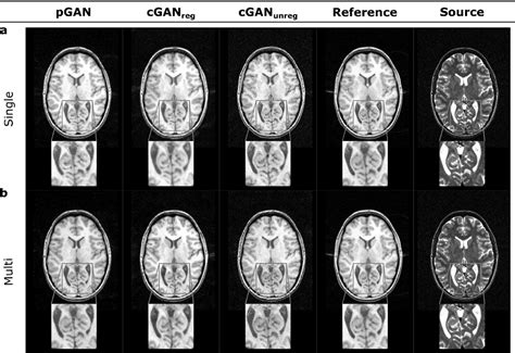 Figure 4 From Image Synthesis In Multi Contrast Mri With Conditional