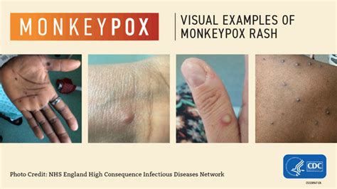 Mpox (Monkeypox Virus) – Urban Indian Health Institute