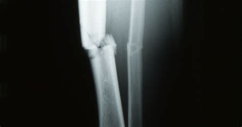 Ultrasound Treatment To Heal Bone Fractures Approved By Nhs Huffpost