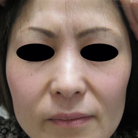 Wrinkle Severity Rating Scale Wsrs Download Table