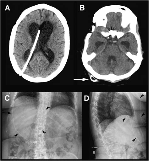 Hydrocephalus Shunt Mri