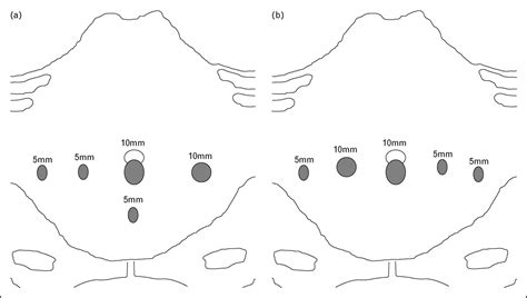 Laparoscopic Radical Cystectomy With Urinary Diversion What