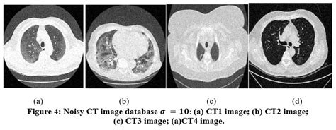 A Hybrid Approach For Ct Image Noise Reduction Combining Method Noise Cnn And Shearlet Transform