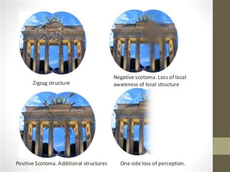 I Seem To Have Scintillating Scotoma