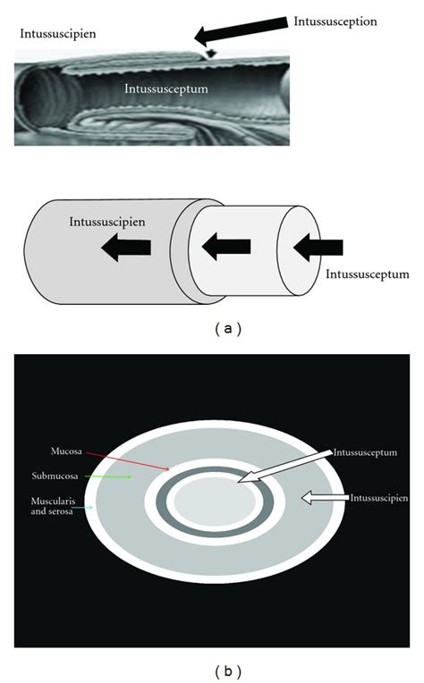 Intussusception Target Sign