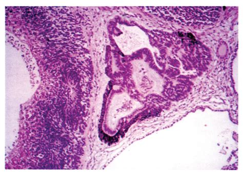 Clinicopathological Features Of Immature Neck Teratoma Annals Of