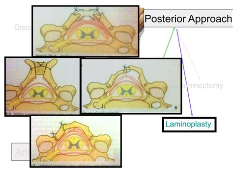 Laminectomy Vs Discectomy In Rehabilitation Ppt