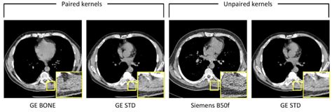 Inter Vendor Harmonization Of Ct Reconstruction Kernels Using Unpaired
