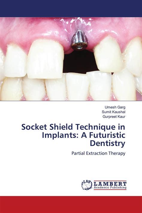 Socket Shield Technique In Implants A Futuristic Dentistry 978 620 5