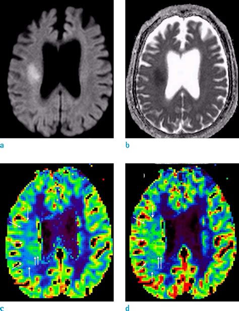 Hyperperfusion In Dwi Abnormality In A Patient With Acute Symptomatic