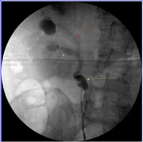 Retrograde Pyelogram Showing Bifurcation At The Proximal Ureter Yellow