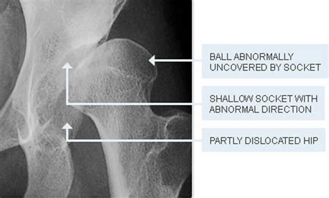 Acetabular Dysplasia Causes Symptoms Diagnosis Treatment And Prognosis
