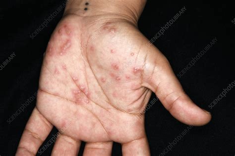 Pustular Palmoplantar Psoriasis Stock Image C0602562 Science
