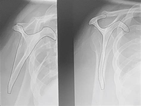 Shoulder Injuries Approach And Dislocations Emergency Medicine Cases