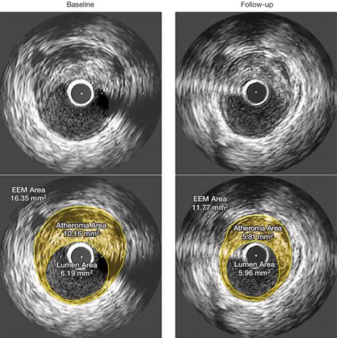 Example Of Regression Of Atherosclerosis In A Patient In The Trial