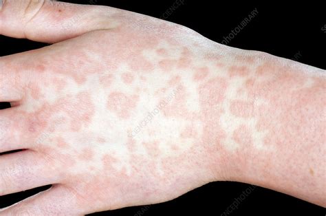 Epstein Barr Virus Infection Stock Image C025 9599 Science Photo Library