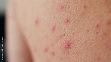 Close Up Of Chicken Pox On The Back Of An Adult Person The Classic