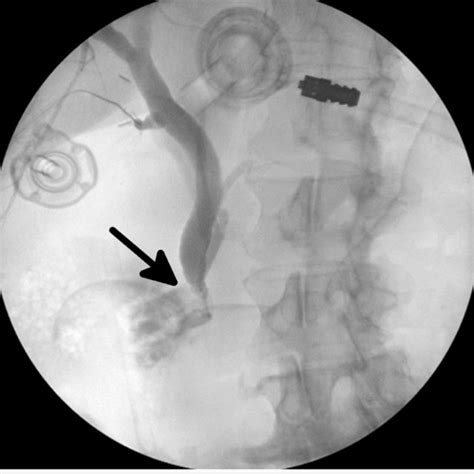 Intraoperative Cholangiogram Following Glucagon Administration In
