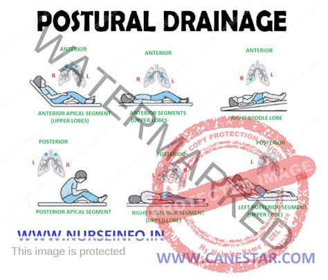 Examples Of Postural Supports At Jack Daniels Blog