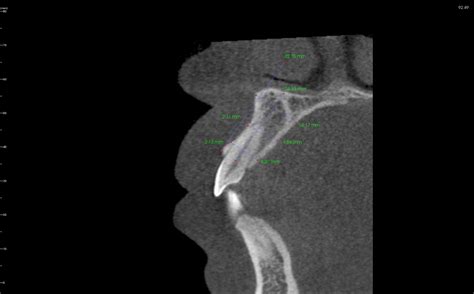 Cone Beam Computerized Tomography Measurement Of Alveolar Ridge Dimension At Anterior Maxilla