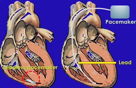 Differenza Tra Loop Recorder E Pacemaker At Darlene Thompson Blog
