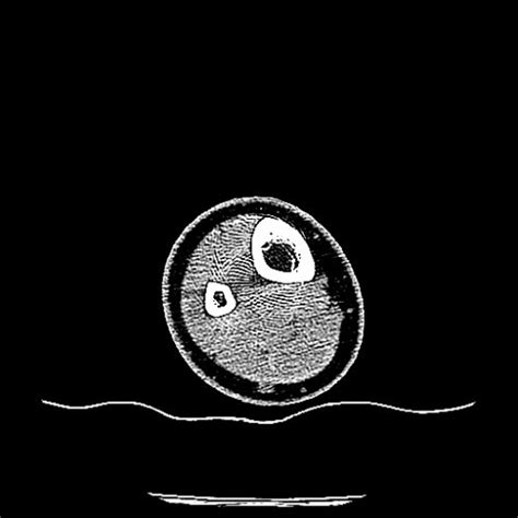 Tibia Recurvatum Lower Extremity Cts