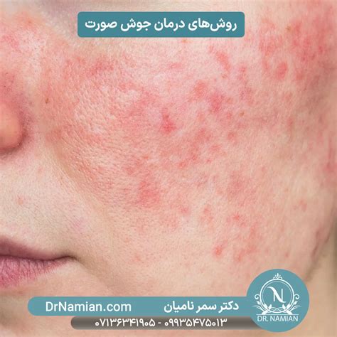 درمان جوش صورت در شیراز و بهترین روشهای آن دکتر نامیان