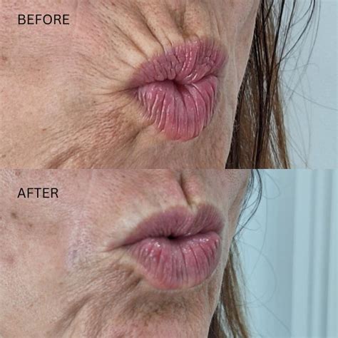 Upper Lip Lines Elegance Skin Clinic