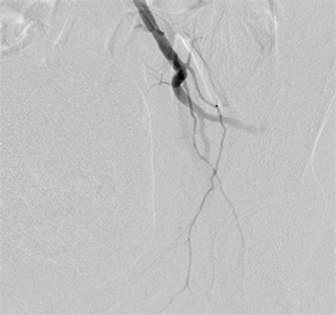 Post Embolization With Gelfoam Showing Resolution Of The Contrast