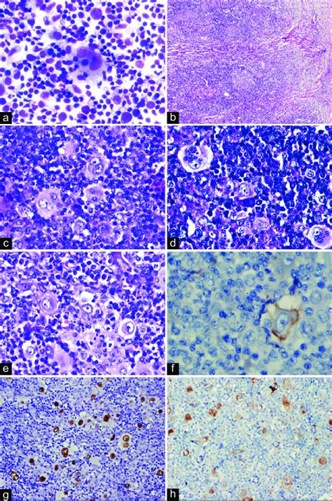 Cytology Shows Multinucleate Cells In A Polymorphous Background B Download Scientific