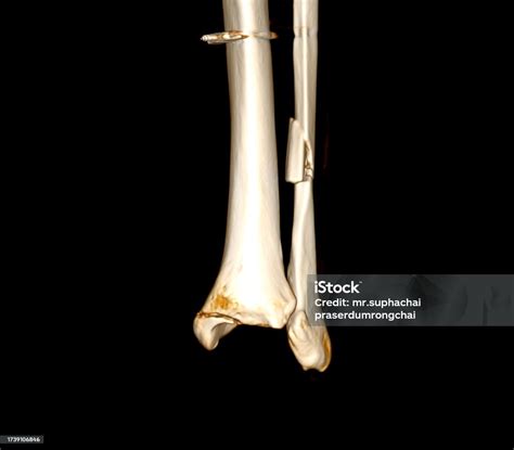 Ct 스캔 발목 관절 골절 경골 및 비골 뼈를 보여주는 3d 렌더링 이미지 3d 스캔에 대한 스톡 사진 및 기타 이미지 3d 스캔 3차원 형태 Cat 스캔 Istock