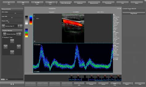 Color Doppler Imaging DWL