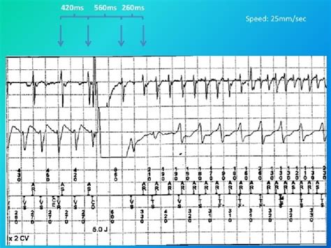 The Upper Tracing Indicates Near Field Atrial Electrogram The Middle