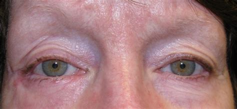 Lower Eyelid Cancer Reconstruction