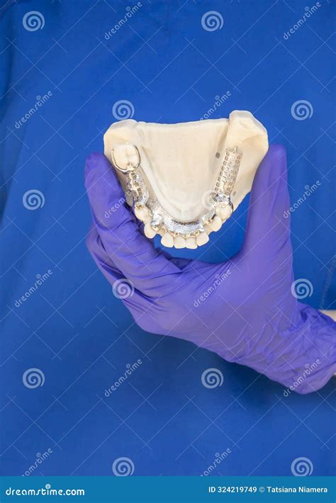 Lower Partial Denture With Attachments Royalty Free Stock Image