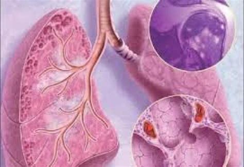 Саркоидоз легких признаки причины симптомы лечение и профилактика Idoctor Kz