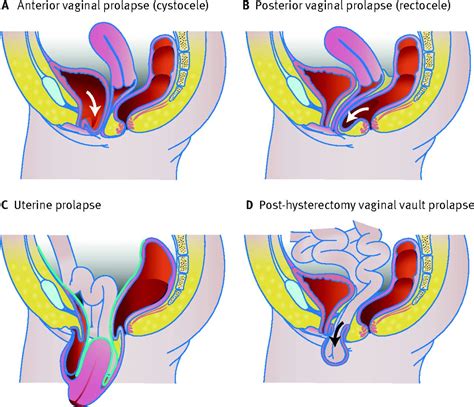 Cystocele Grading
