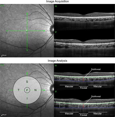 Illustration Of The Oct Scanning Protocol And Image Analyses Performed