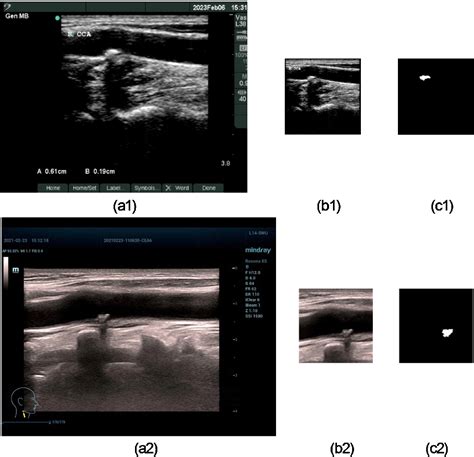 Figure 1 From A New Network For Carotid Artery Plaque Segmentation In Ultrasound Images